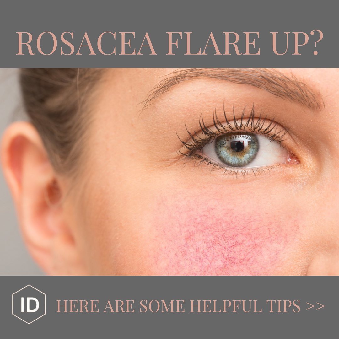Rosacea Flare – Institute of Dermatologists
