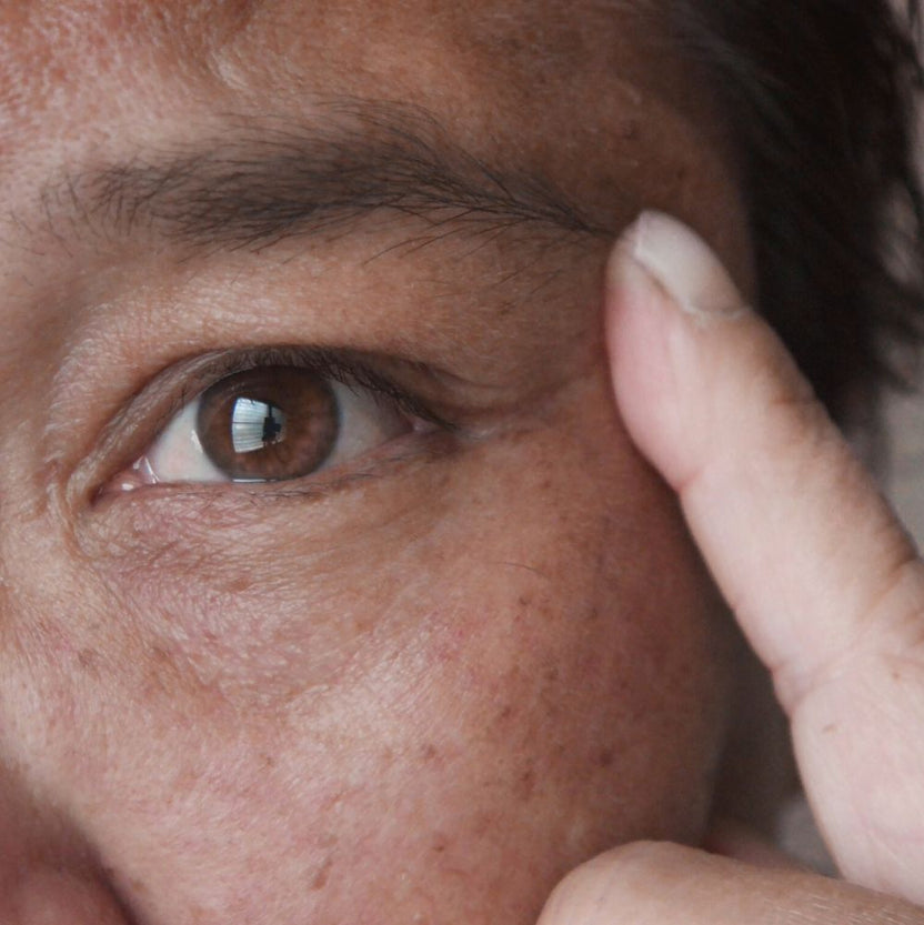 Pigmentation Treatments | Institute of Dermatologists Ireland